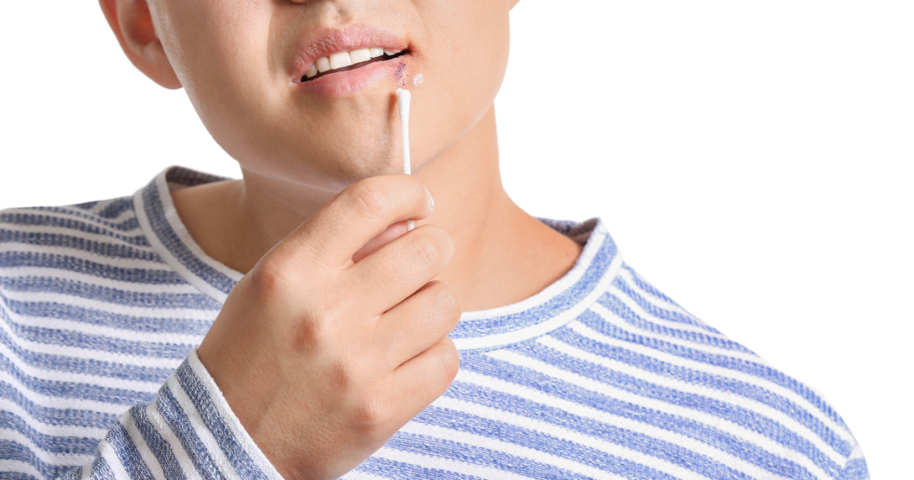 Cold Sore Community | How to Treat Cold Sores FAST: Proven Methods for ...